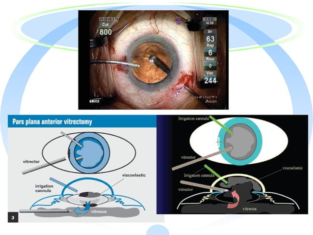 Anterior vitrectomy | PPT | Eye and Vision Conditions | Diseases and ...