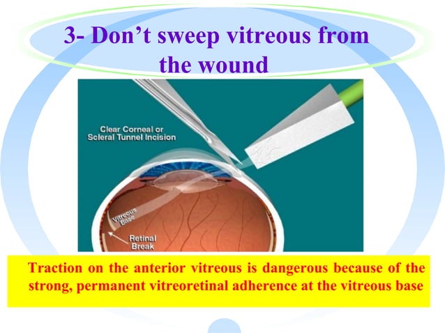 Anterior vitrectomy | PPT | Eye and Vision Conditions | Diseases and ...
