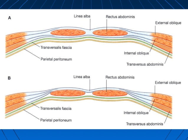 Antero-Lateral Abdominal Wall (Anatomy of the Abdomen) | PPS