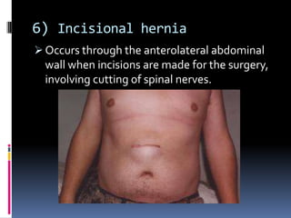 Anterolateral abdominal wall (rectus sheath) & hernia