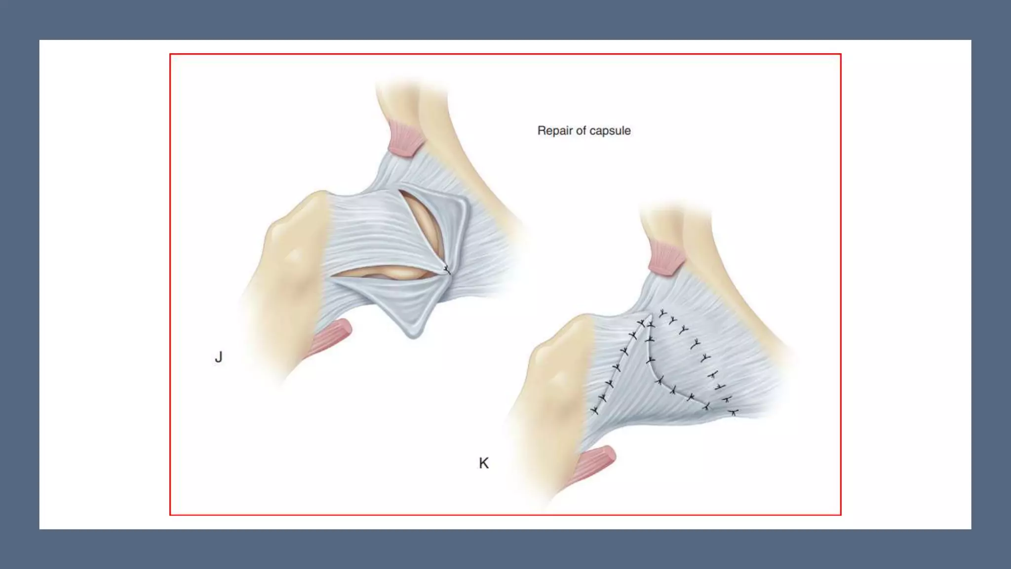 Anterolateral approach to hip joint (DDH).pptx