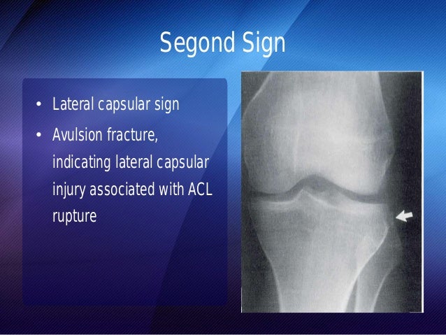 Anterolateral Ligament (ALL)