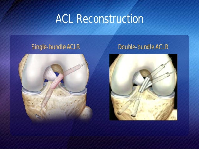 Anterolateral Ligament (ALL)