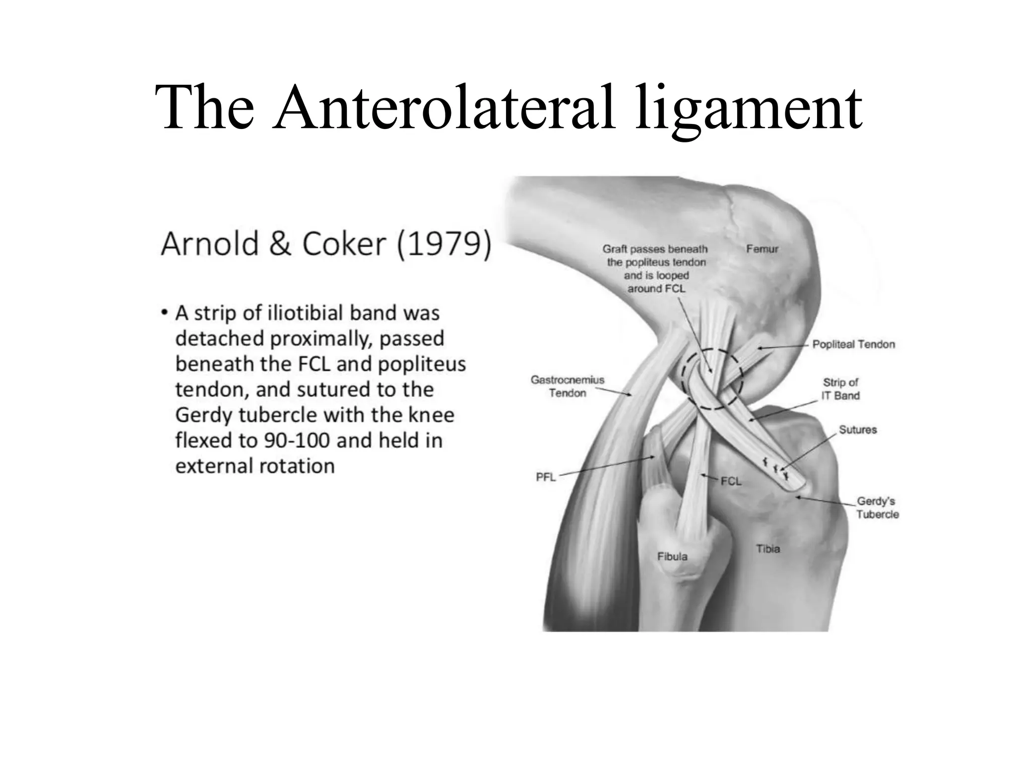The Antero-lateral ligament "the whole story" | PPTX