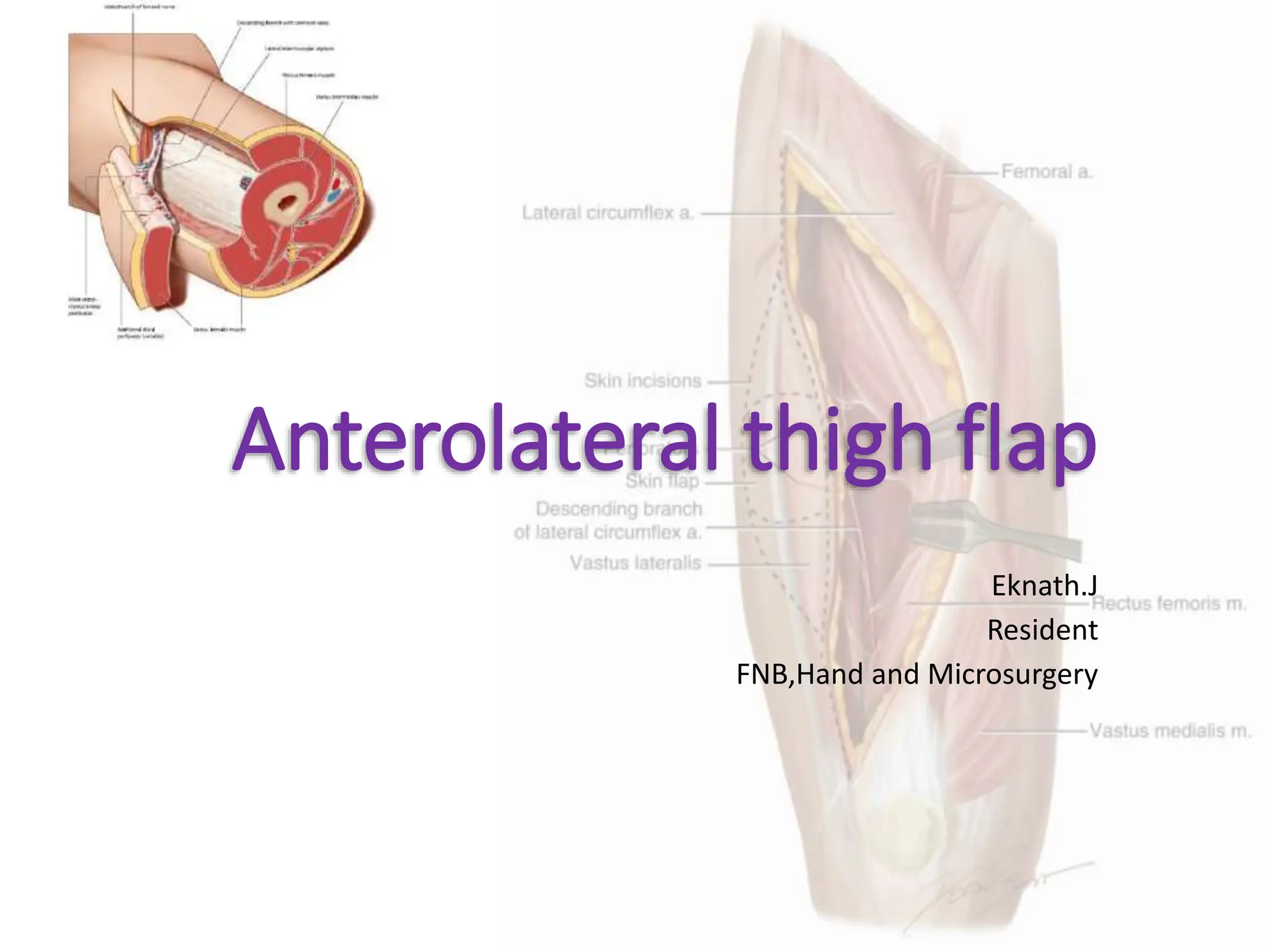 Anterolateral thigh flap.pptx