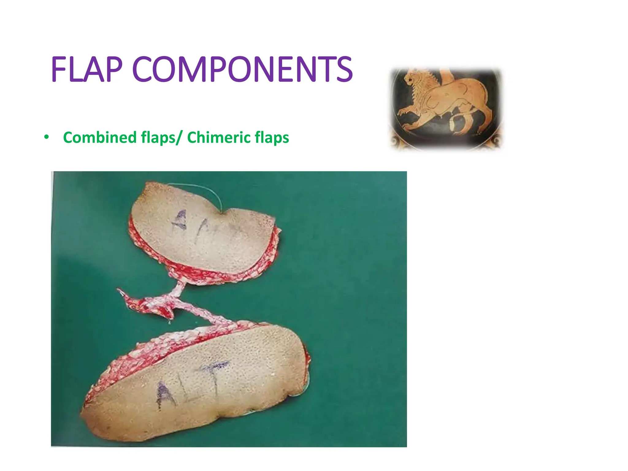 Anterolateral thigh flap.pptx
