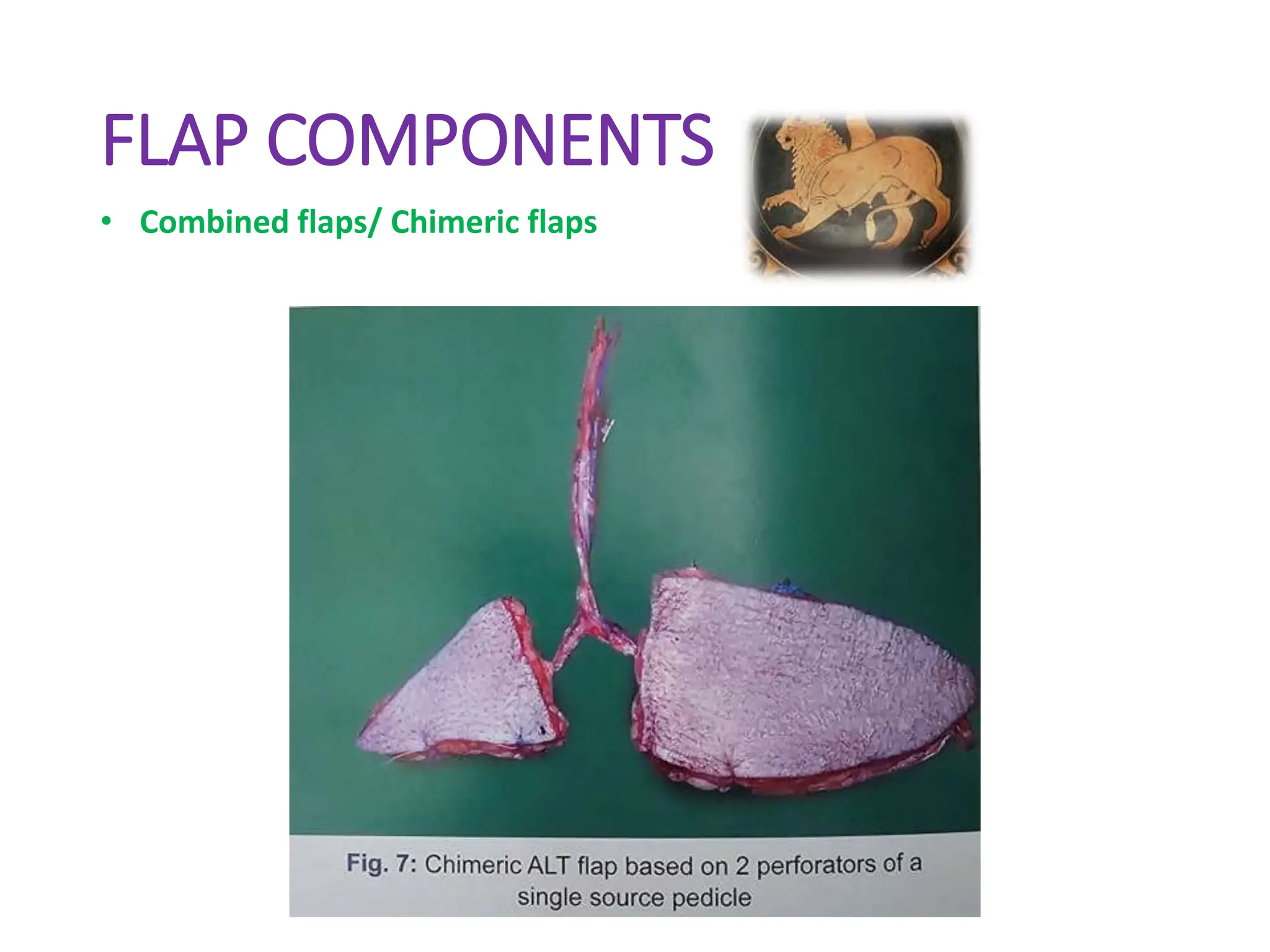 Anterolateral thigh flap.pptx