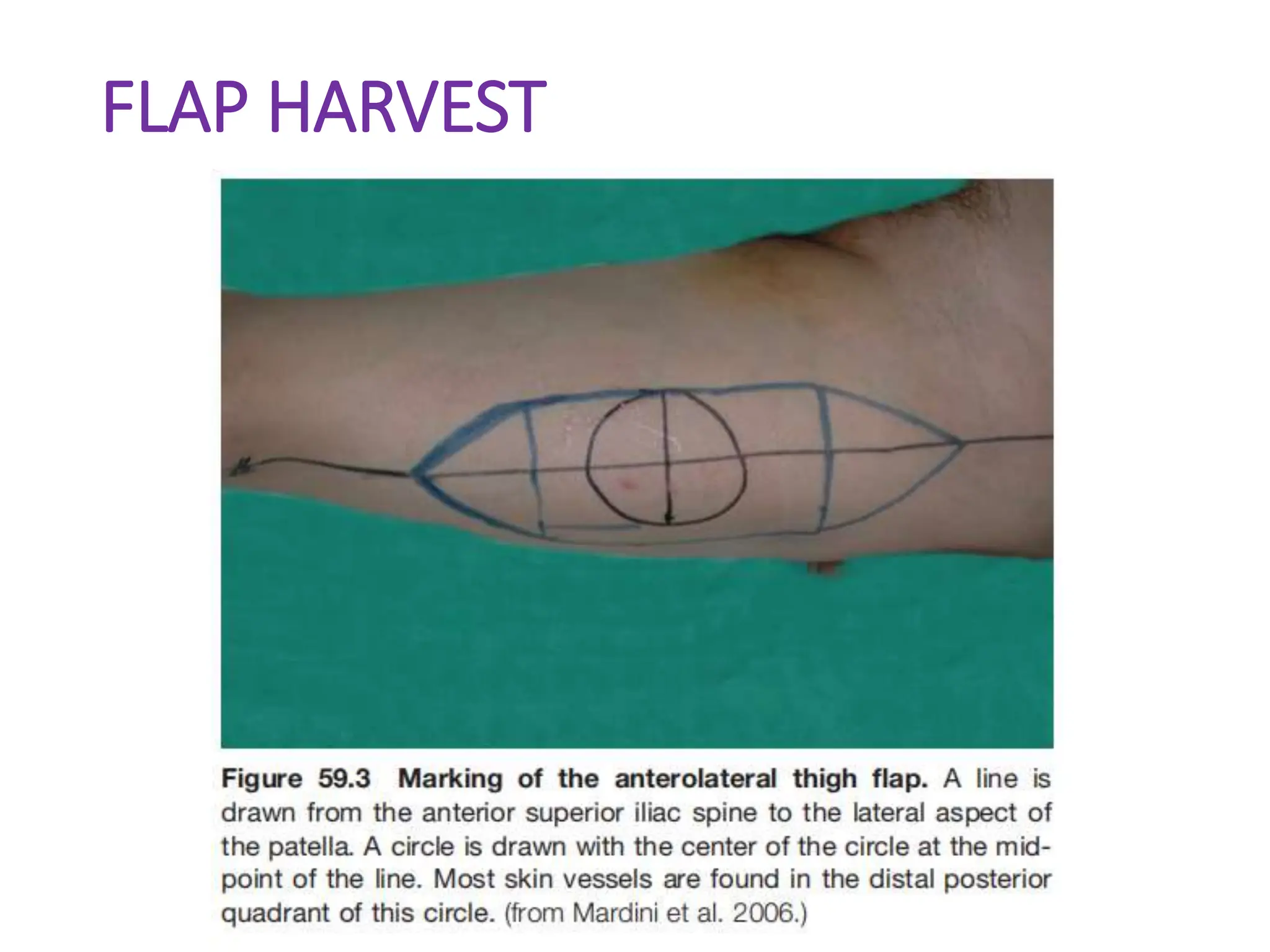 Anterolateral thigh flap.pptx