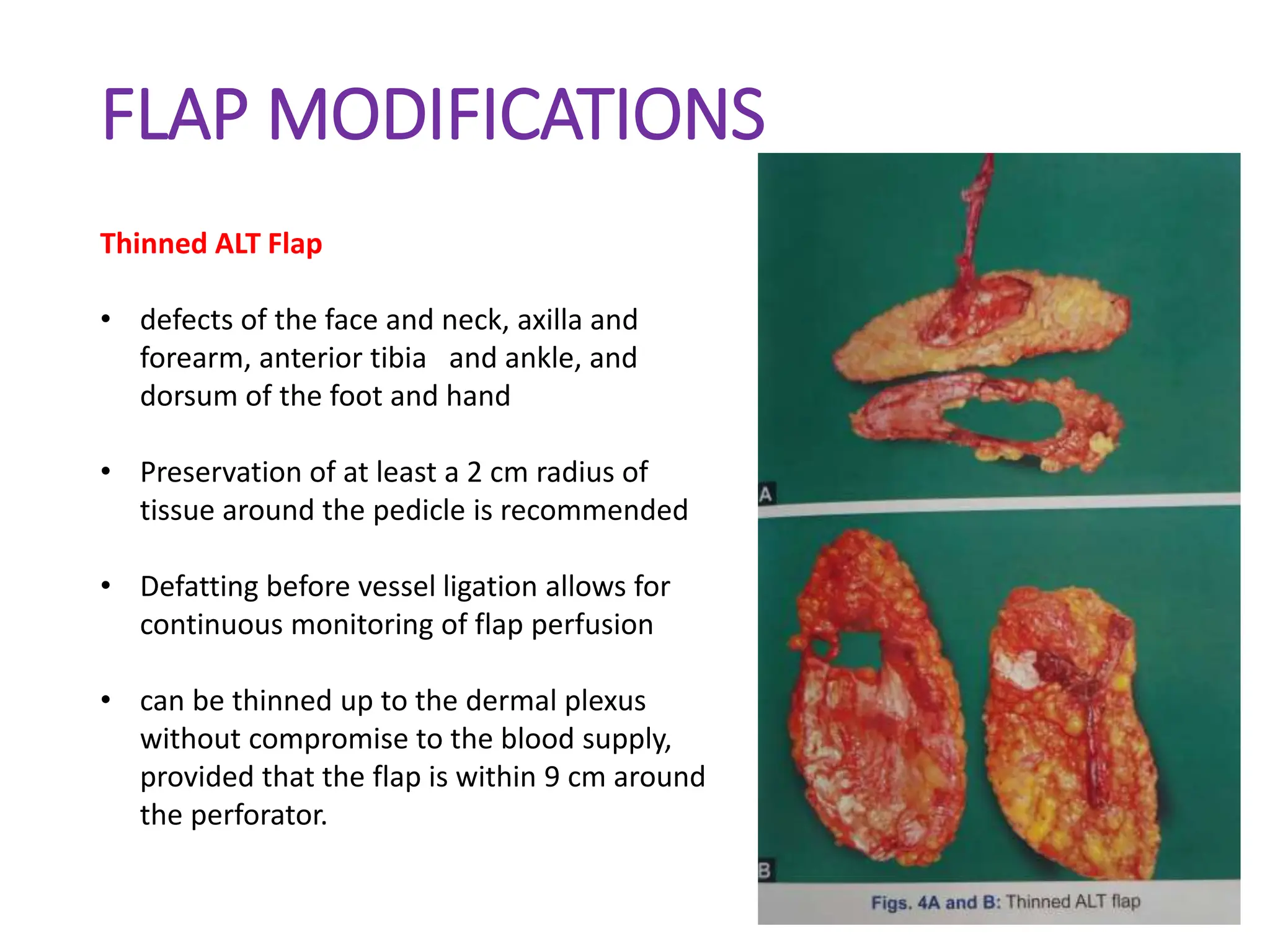 Anterolateral thigh flap.pptx