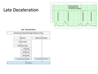Subtle Late Decelerations