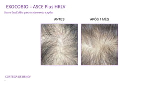 ANTES E DEPOIS - EXOCOBIO_ASCEplus HRLV.pptx