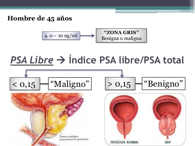 Antígeno prostático específico
