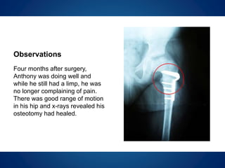Anthony: Legg-Calve-Perthes Disease Case Study | PPTX