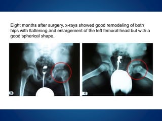 Anthony: Legg-Calve-Perthes Disease Case Study | PPTX