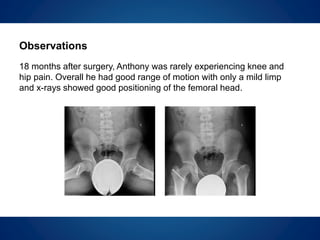 Anthony: Legg-Calve-Perthes Disease Case Study | PPTX