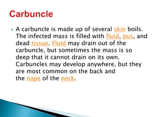 Anthracinum – Materia Medica | PPTX