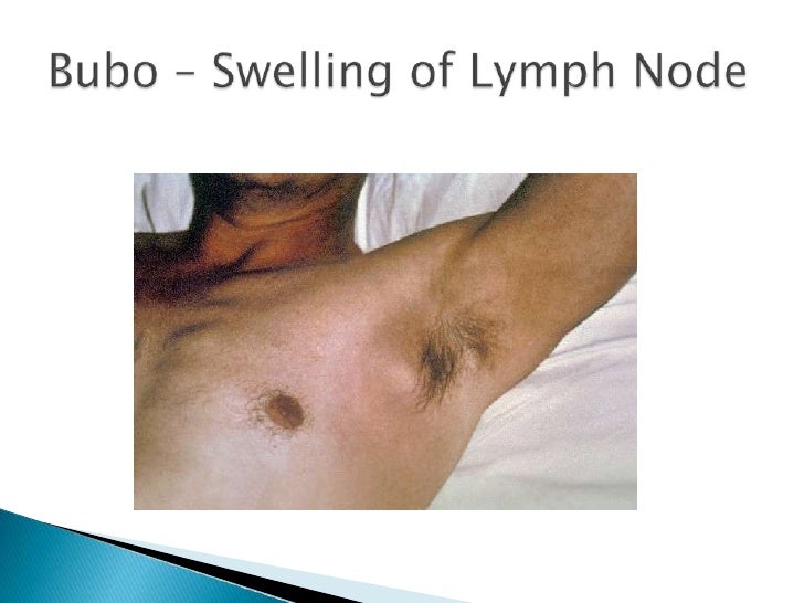 Anthracinum – Materia Medica