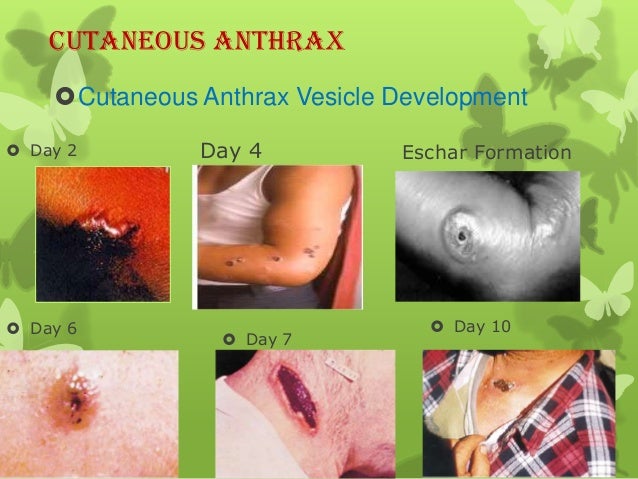 Anthrax