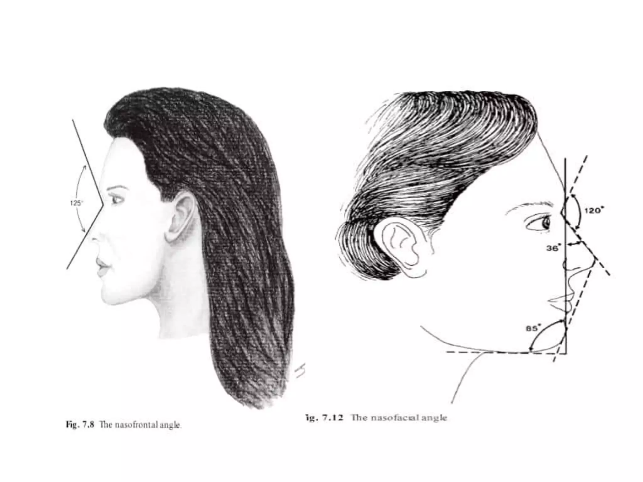 Anthropometry and cephalometric facial analysis | PPTX