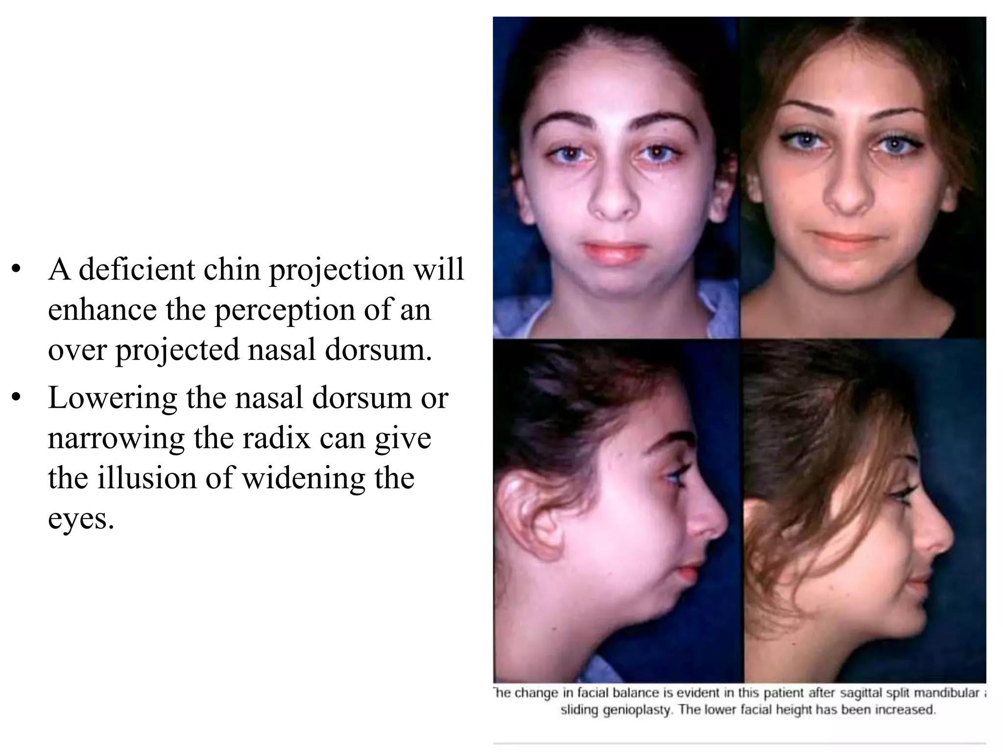 Anthropometry and cephalometric facial analysis | PPTX