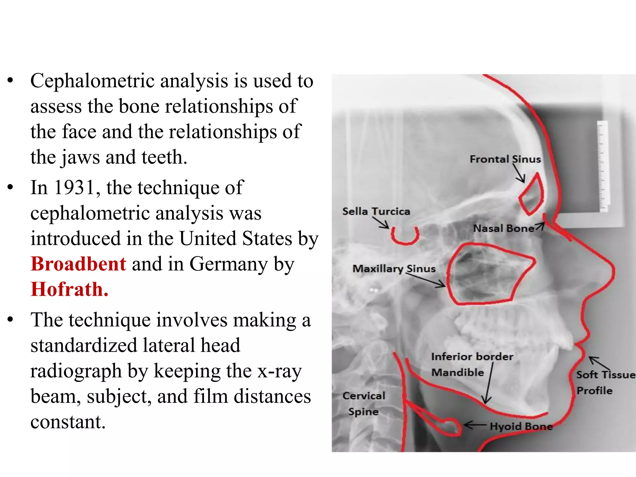 Anthropometry and cephalometric facial analysis | PPTX