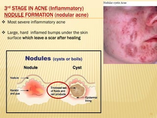 Anti-acne Preparations | PDF
