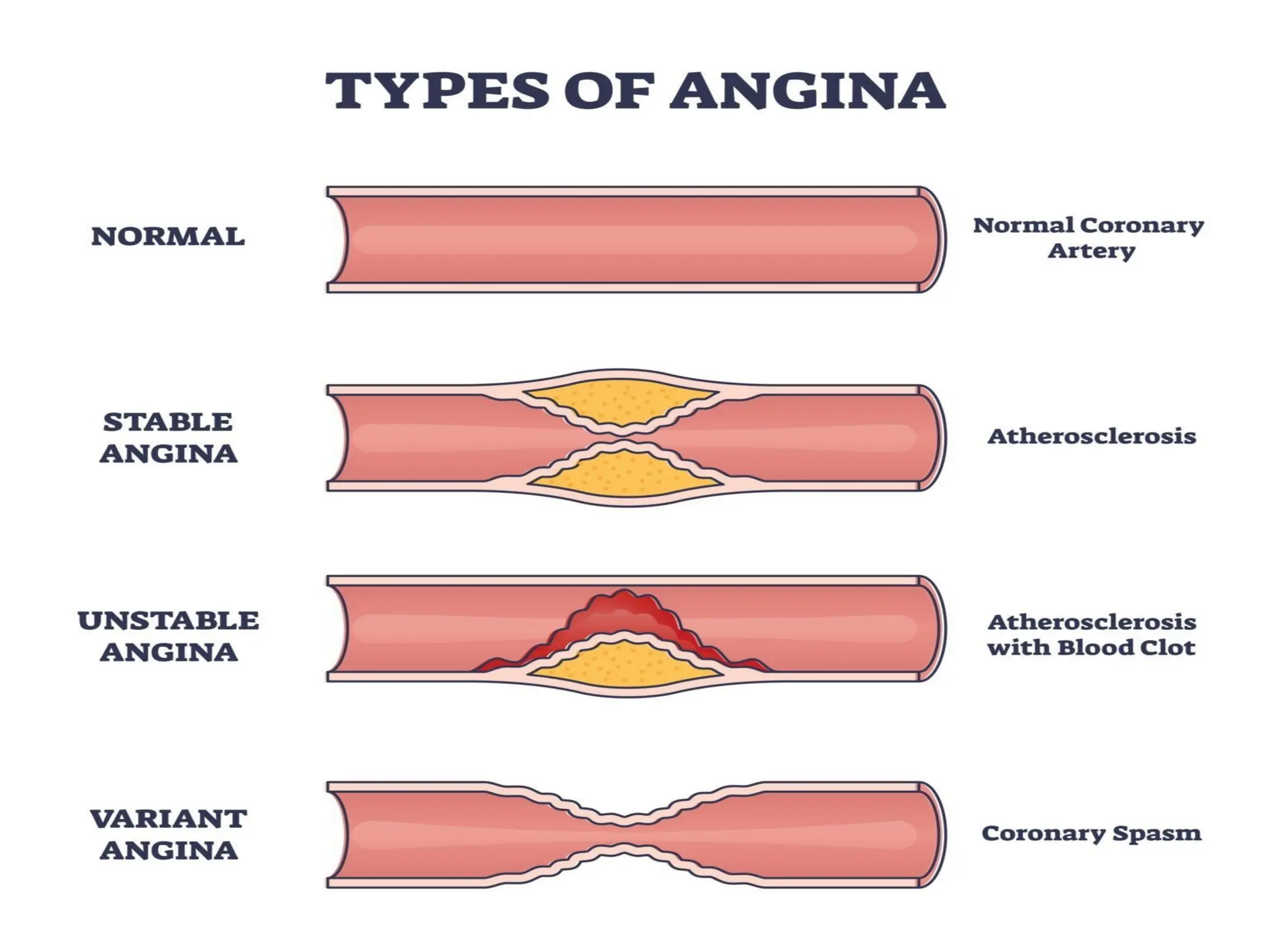 Anti-anginal drugs, pathophysiology, their mechanism of action and ...