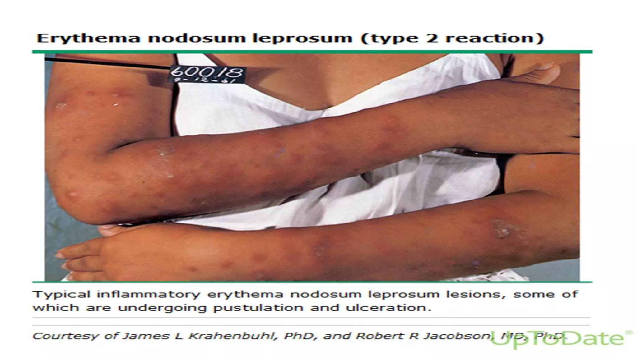 Anti leprosy drugs | PPTX