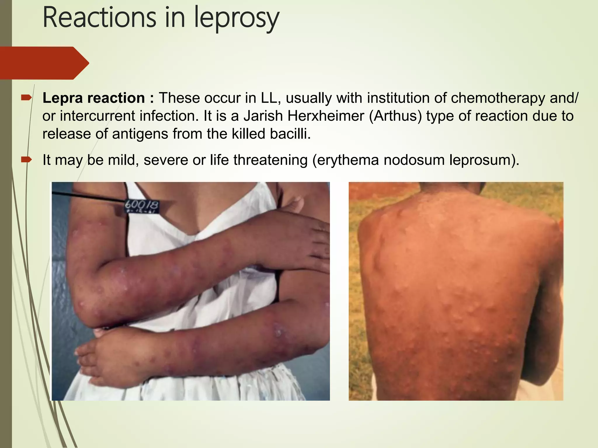 Leprosy & Anti-Leprotic Drugs | PPTX