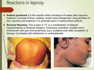 Leprosy & Anti-Leprotic Drugs | PPT