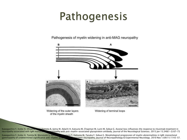 Anti-MAG Neuropathy.pptx