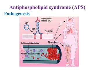 Anti-phospholipid syndrome.pptx