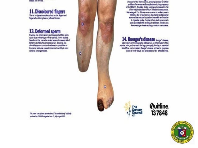 DOH Anti-Smoking Campaign