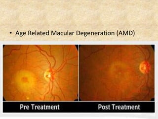 Anti vegf intravitreal injections | PPTX