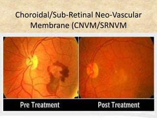 Anti vegf intravitreal injections | PPT