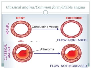 Pharmacology of Drugs used in Treatment of angina | PPTX