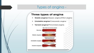 Antianginal drugs | PDF