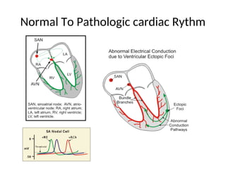 Arrhythmia/ dysrhythmia means an abnormal or irregular heart beat | PPT