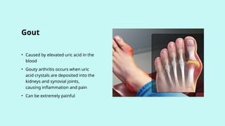 Nursing Pharmacology Antiarthritis and Antigout Drugs.pptx