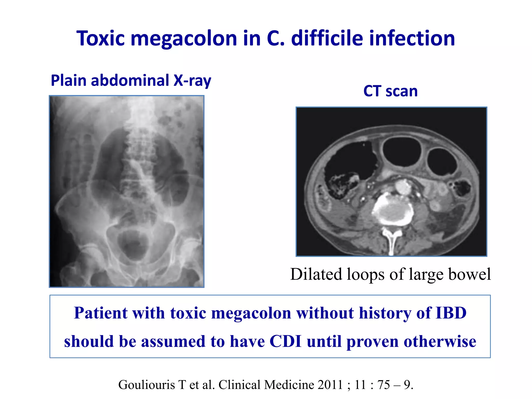 Antibiotic associated diarrhea | PPTX