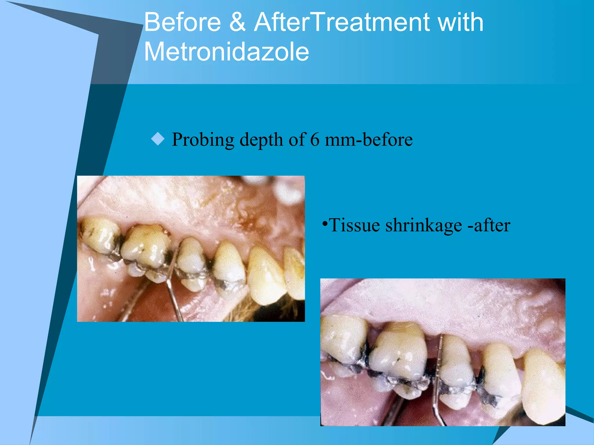 Antibiotic Adjuncts To Perio treatment | PPT