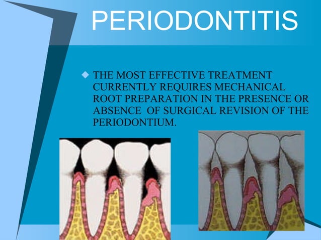 Antibiotic Adjuncts To Perio treatment | PPT