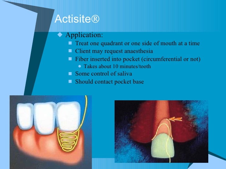 Antibiotic Adjuncts To Perio treatment