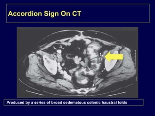 Antibiotic associated diarrhea & Clostridium difficile infection | PPTX