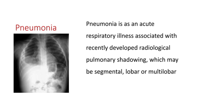 Antibiotics for pneumonia | PPTX