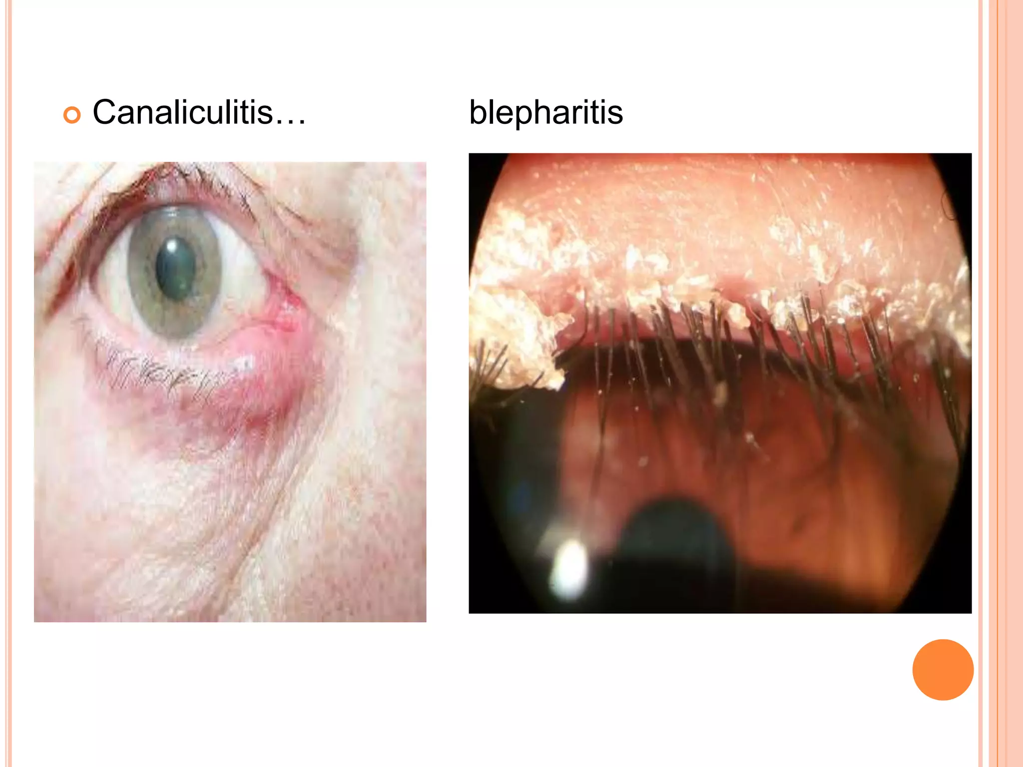 Antibiotics in ophthalmology | PPTX