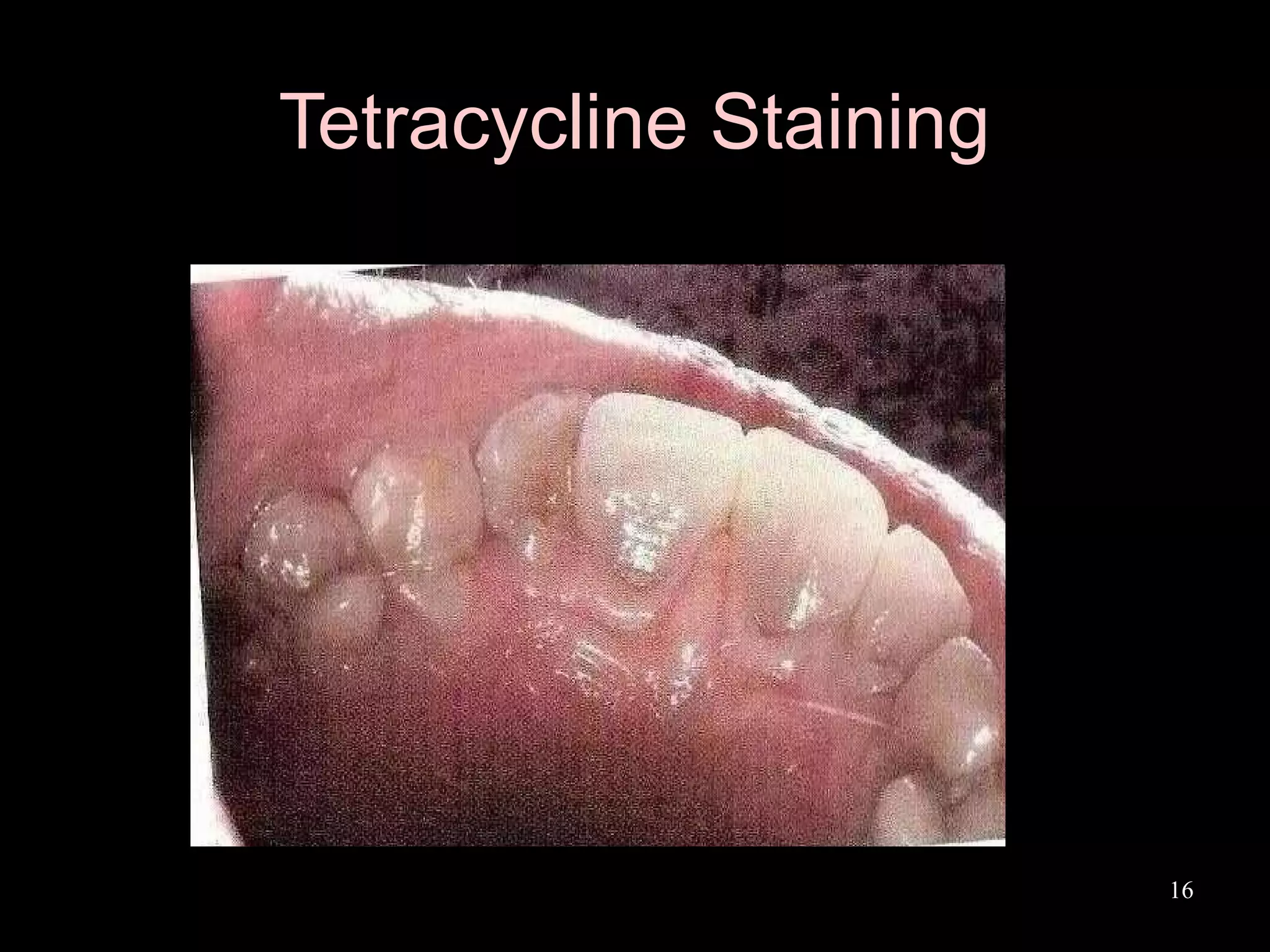 Antibiotics in periodontics | PPT