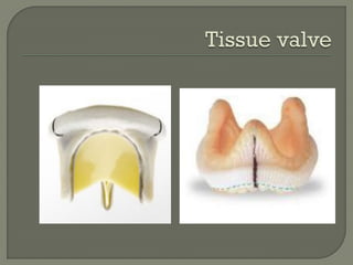 ANTICOAGULATION POST VALVE SURGERY present | PDF