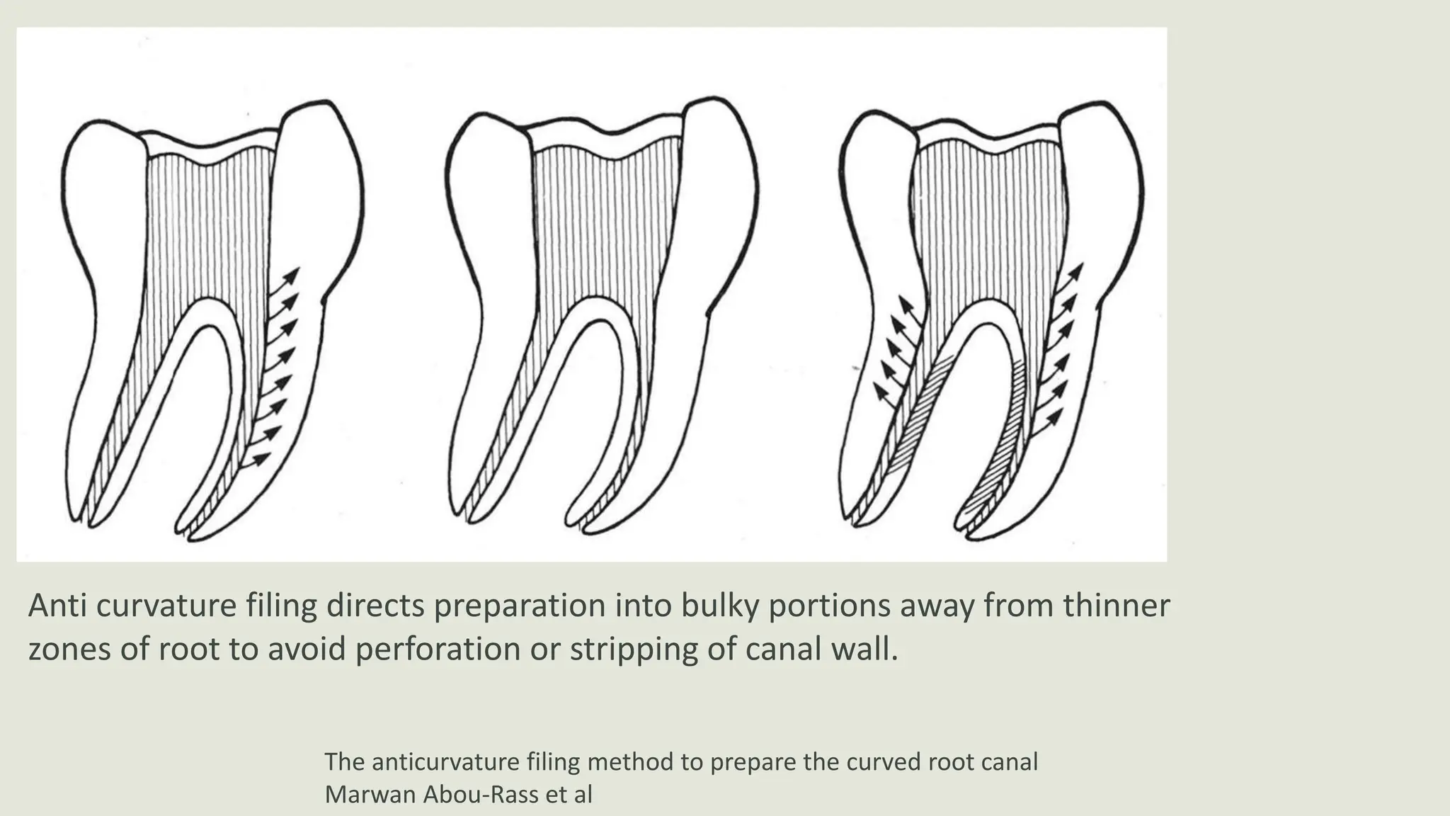 ANTICURVATURE FILING TECHNIQUE ENDO.pptx