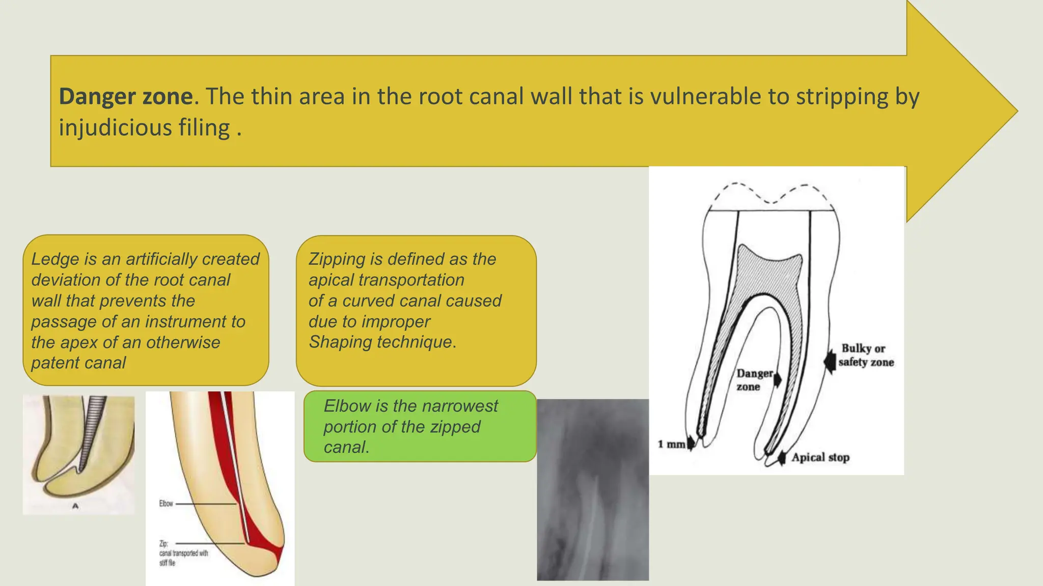 ANTICURVATURE FILING TECHNIQUE ENDO.pptx
